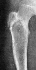 LearningRadiology-Bone Tumors
