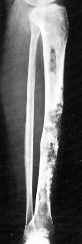 LearningRadiology-Bone Tumors