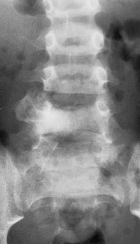 LearningRadiology-Bone Tumors