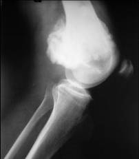 LearningRadiology-Bone Tumors