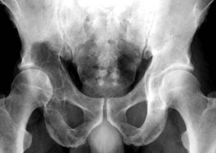 LearningRadiology-Bone Tumors