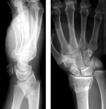 Fractures with Names