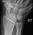 Fractures with Names