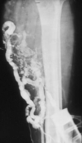LearningRadiology.com - Soft Tissue Calcification and Ossification
