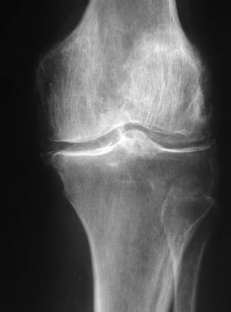 LearningRadiology.com - Soft Tissue Calcification and Ossification