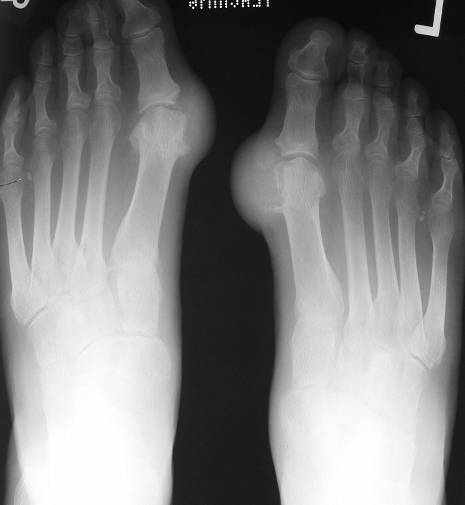 LearningRadiology.com - Soft Tissue Calcification and Ossification
