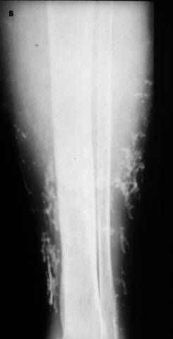 LearningRadiology.com - Soft Tissue Calcification and Ossification