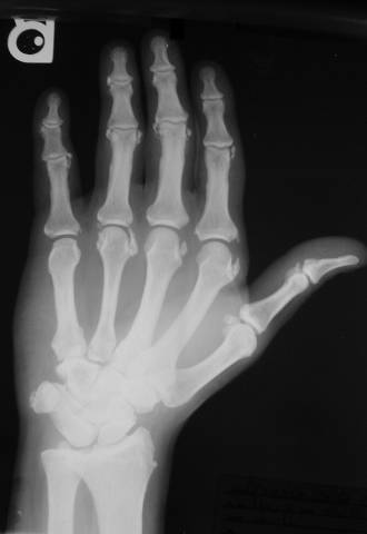 LearningRadiology.com - Soft Tissue Calcification and Ossification