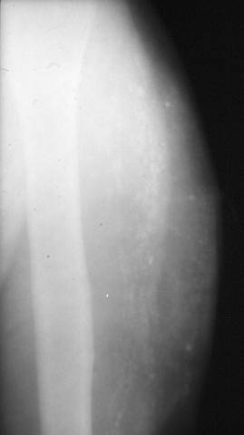 LearningRadiology.com - Soft Tissue Calcification and Ossification