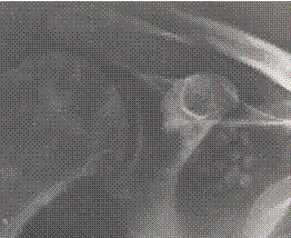 LearningRadiology.com - Soft Tissue Calcification and Ossification