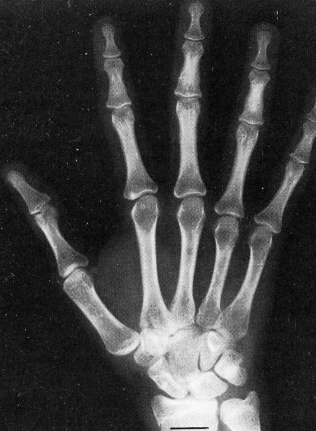 LearningRadiology.com - Soft Tissue Calcification and Ossification