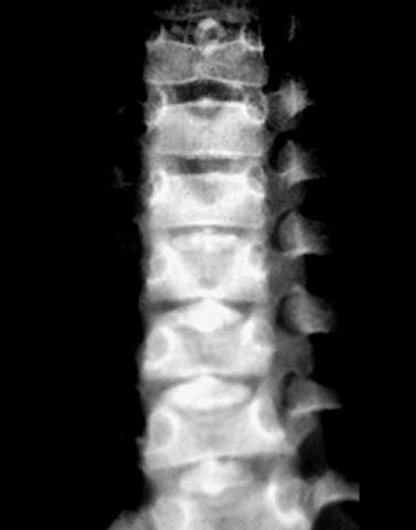 LearningRadiology.com - Soft Tissue Calcification and Ossification