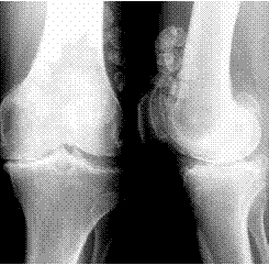 LearningRadiology.com - Soft Tissue Calcification and Ossification