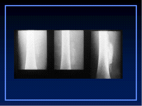 LearningRadiology.com - Soft Tissue Calcification and Ossification
