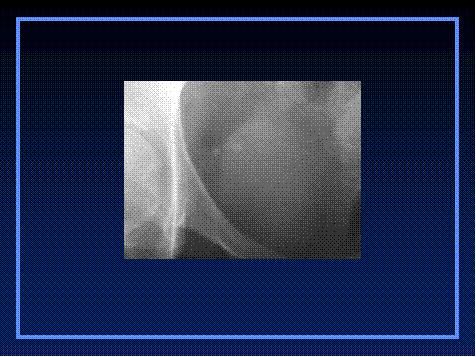 LearningRadiology.com - Soft Tissue Calcification and Ossification