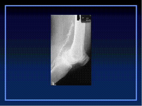 LearningRadiology.com - Soft Tissue Calcification and Ossification