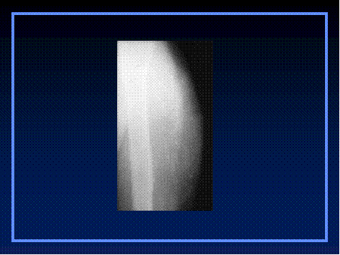 LearningRadiology.com - Soft Tissue Calcification and Ossification