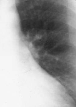 LearningRadiology - ABCs of Heart Disease