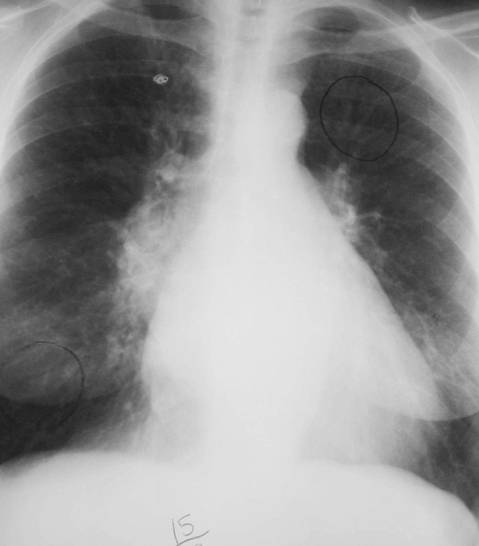 LearningRadiology - ABCs of Heart Disease