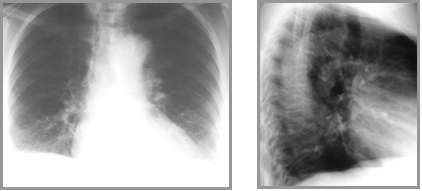 LearningRadiology - Diseases of the Great Vessels