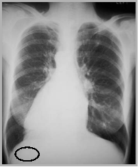 LearningRadiology - Heterotaxy Syndromes, Cardiac Malpositions, Sinus ...