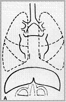 LearningRadiology - Heterotaxy Syndromes, Cardiac Malpositions, Sinus ...