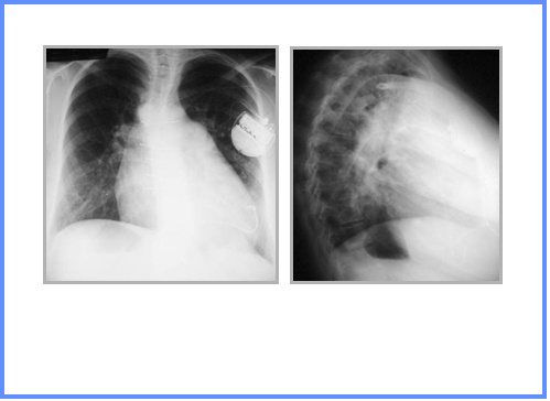 LearningRadiology - Heterotaxy Syndromes, Cardiac Malpositions, Sinus ...