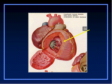 LearningRadiolgy.comn- Valvular Lesions of the Heart,pulmonic,tricuspid ...
