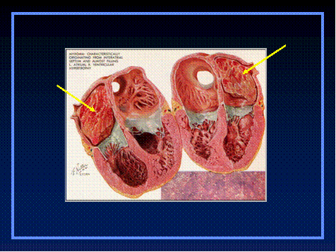 LearningRadiolgy.comn- Valvular Lesions of the Heart,pulmonic,tricuspid ...
