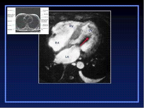 LearningRadiolgy.comn- Valvular Lesions of the Heart,pulmonic,tricuspid ...
