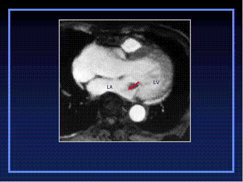 LearningRadiolgy.comn- Valvular Lesions of the Heart,pulmonic,tricuspid ...