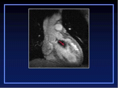 LearningRadiolgy.comn- Valvular Lesions of the Heart,pulmonic,tricuspid ...
