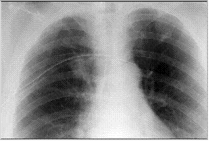 The Fundamentals of Chest Roentgenology