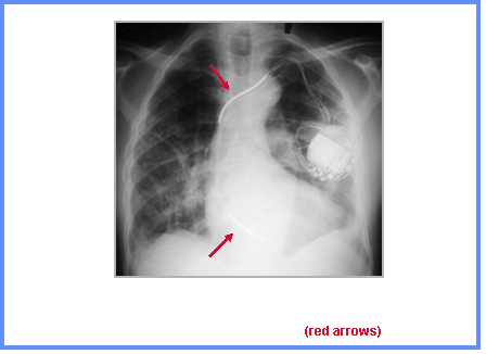 The Fundamentals of Chest Roentgenology