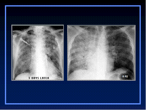 LearningRadiology - Pneumonia
