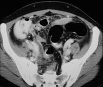 LearningRadiology.com-Acute Abdominal Pain and CT