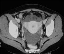 LearningRadiology.com-Acute Abdominal Pain and CT