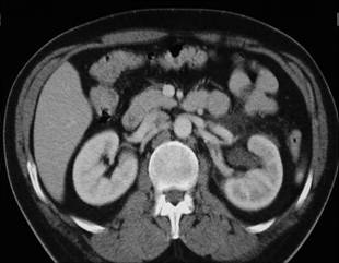 LearningRadiology.com-CT of Blunt Abdominal Trauma,renal,hepatic,liver ...