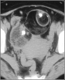 LearningRadiology.com-Flank Pain