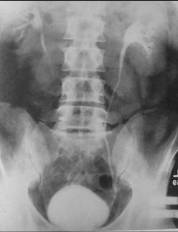 LearningRadiology.com-Basics of Intravenous Urography,IVP,IVU