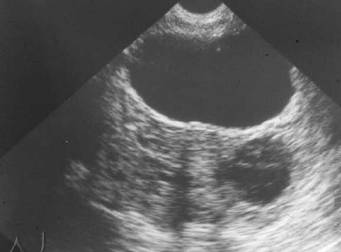 LearningRadiology.com-Imaging in PID, US and CT,pelvic,inflammatory ...