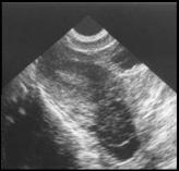 LearningRadiology.com-Imaging in PID, US and CT,pelvic,inflammatory ...