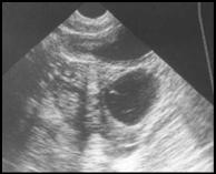 LearningRadiology.com-Imaging in PID, US and CT,pelvic,inflammatory ...