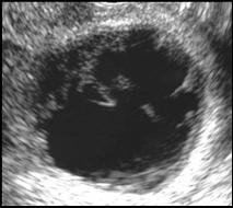 Salpingitis Laparoscopy