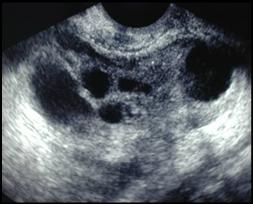 LearningRadiology.com-Imaging in PID, US and CT,pelvic,inflammatory ...