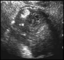 LearningRadiology.com-Imaging in PID, US and CT,pelvic,inflammatory ...