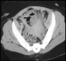 LearningRadiology.com-Imaging in PID, US and CT,pelvic,inflammatory ...