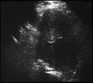 LearningRadiology.com-Imaging in PID, US and CT,pelvic,inflammatory ...