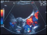 LearningRadiology.com-Imaging in PID, US and CT,pelvic,inflammatory ...