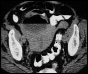 LearningRadiology.com-Imaging in PID, US and CT,pelvic,inflammatory ...